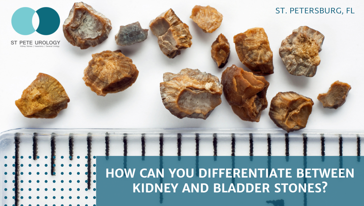 How Can You Differentiate Between Kidney And Bladder Stones St Pete How Can You Differentiate Between Kidney And Bladder Stones St Pete
